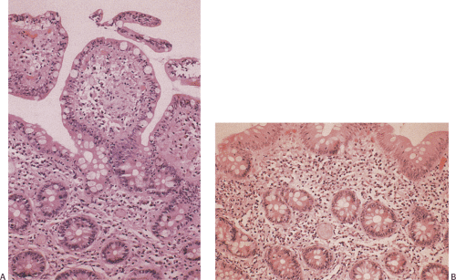 Autoimmune Enteropathy | Abdominal Key