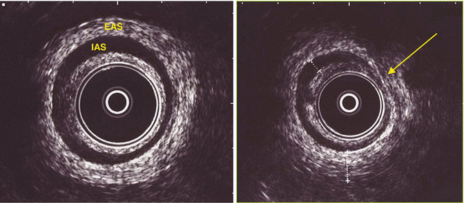 Anorectum | Abdominal Key
