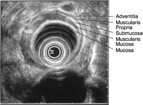 Esophageal Cancer: Anatomy and Staging | Abdominal Key