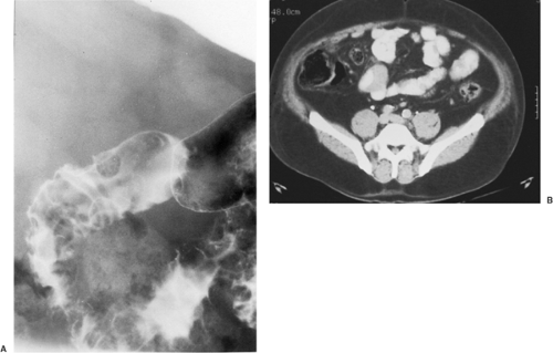 Small Bowel Cancers | Abdominal Key