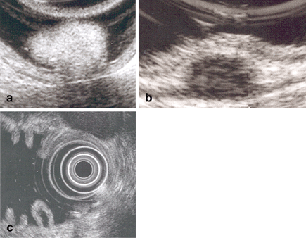 EUS and EUS-FNA of Intramural Masses of the Esophagus, Stomach, and ...