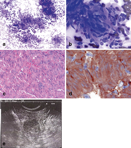 EUS and EUS-FNA of Intramural Masses of the Esophagus, Stomach, and ...