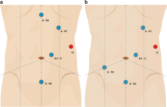 Robotic Right Hemicolectomy | Abdominal Key