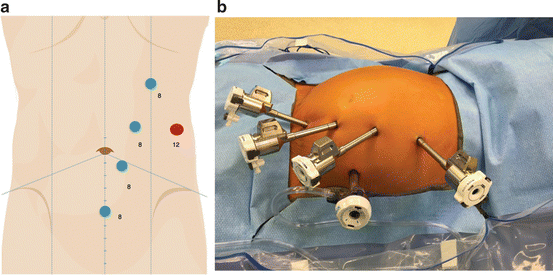 Robotic Right Hemicolectomy | Abdominal Key