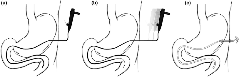 Enteral Feeding Tubes: What Every Fellow Should Know | Abdominal Key