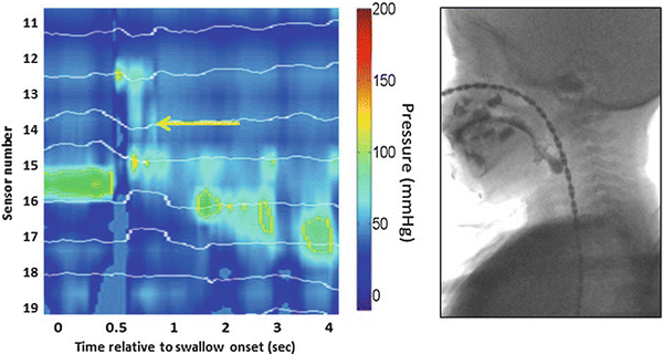 Assessment of Feeding and Swallowing Disorders | Abdominal Key
