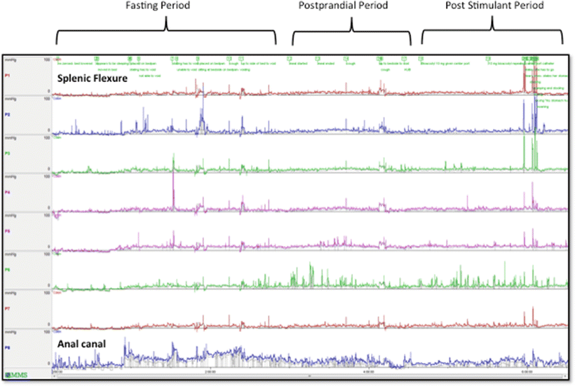 Colonic Manometry | Abdominal Key