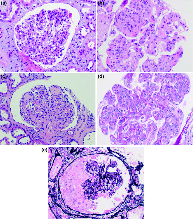 Staphylococcus Infection-Associated Glomerulonephritis | Abdominal Key