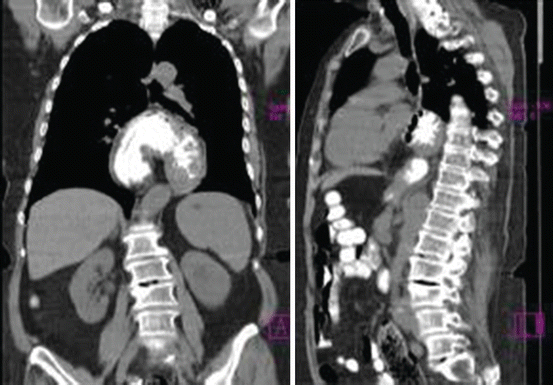 Preoperative Assessment of Failed Fundoplication with Recurrent Hiatal ...