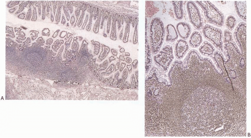 The Nonneoplastic Small Intestine | Abdominal Key