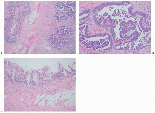 Neoplastic Appendix | Abdominal Key