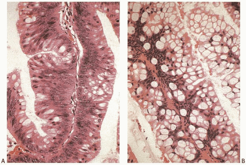 Neoplastic Appendix | Abdominal Key