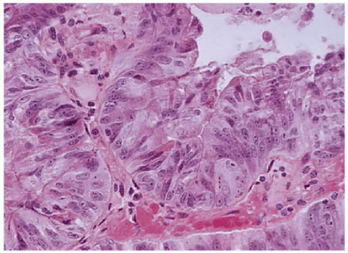 Neoplastic Appendix | Abdominal Key