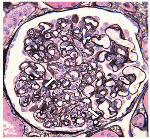 Kidney Allograft Biopsy: Banff Classification and Other Transplant ...