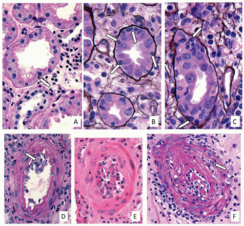 Kidney Allograft Biopsy: Banff Classification and Other Transplant ...