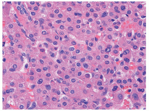 Hepatocellular Carcinoma | Abdominal Key