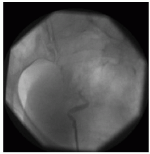 Intraoperative Urology Consultation | Abdominal Key