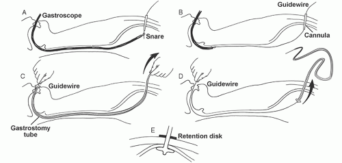 Percutaneous Endoscopic Gastrostomy (PEG), Percutaneous Endoscopic ...