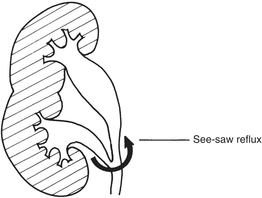 Kidney and Ureter | Abdominal Key