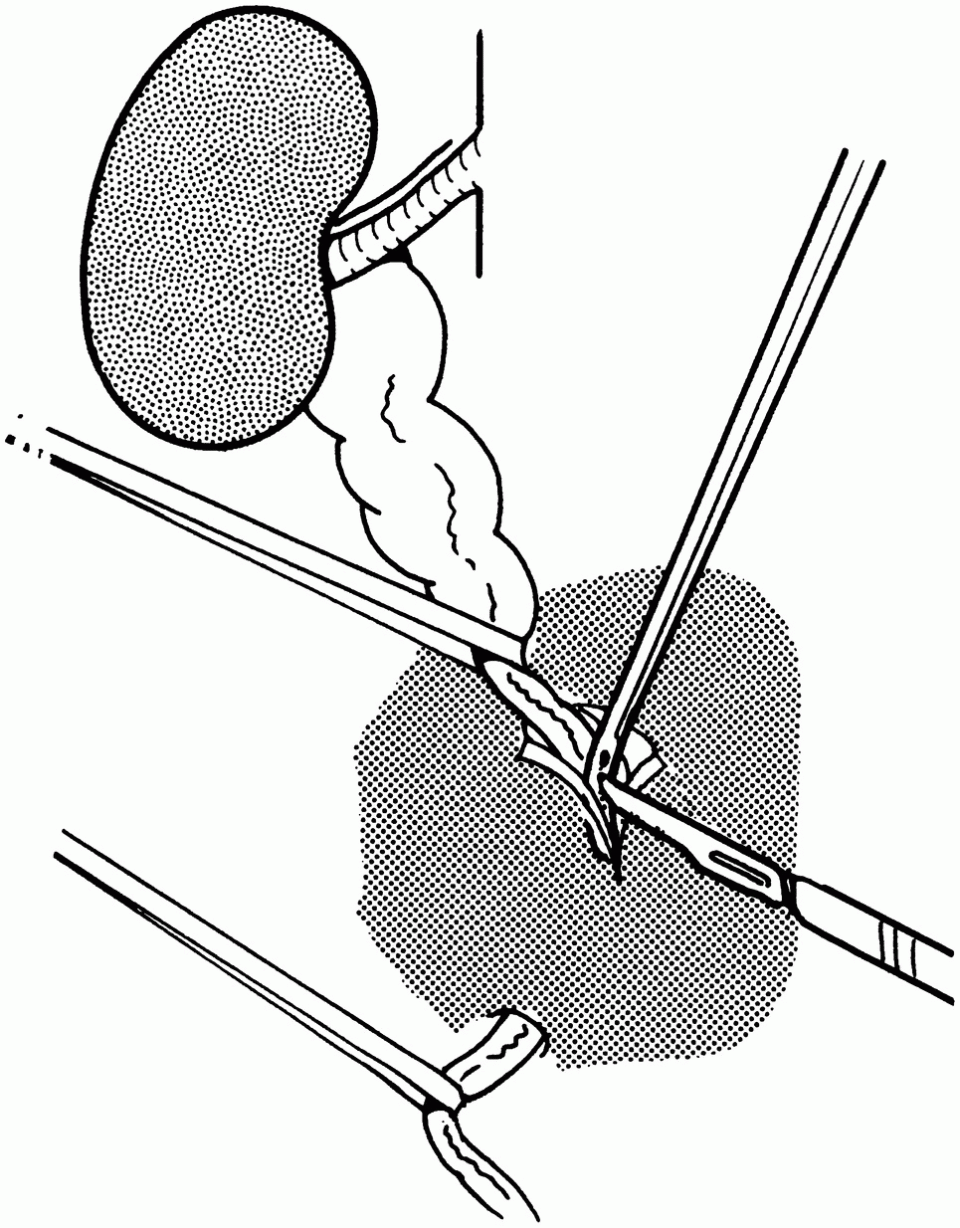 Kidney and Ureter Inflammation | Abdominal Key