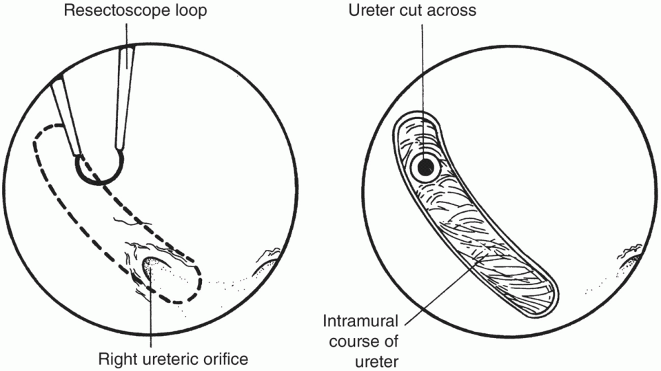 Kidney and Ureter Neoplasm | Abdominal Key