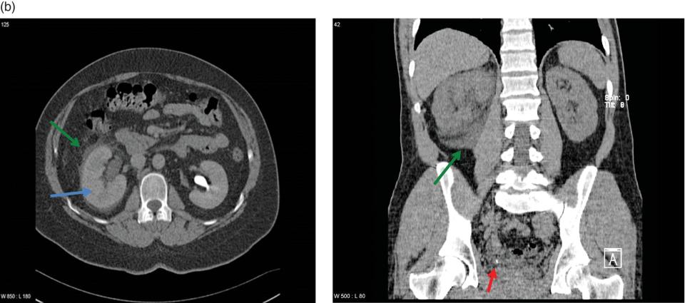 Kidney and Ureter Calculi | Abdominal Key