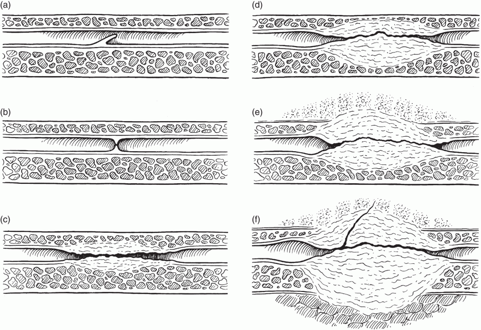 Incision: Endoscopic Management of Urethral Stenoses | Abdominal Key