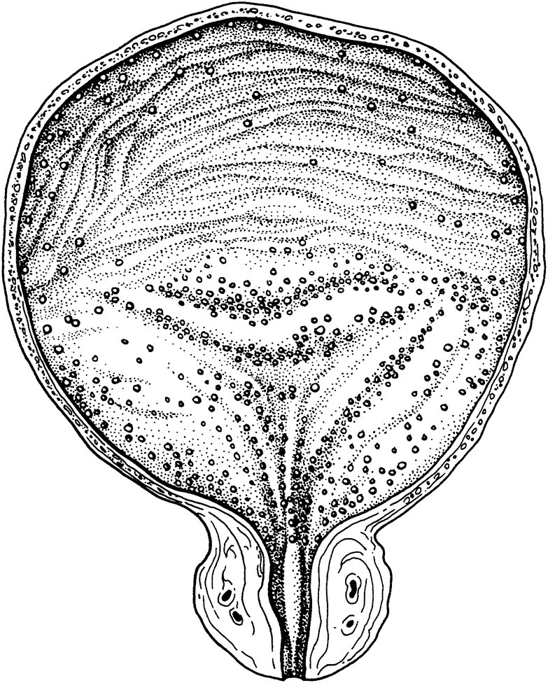 Bladder Inflammation | Abdominal Key