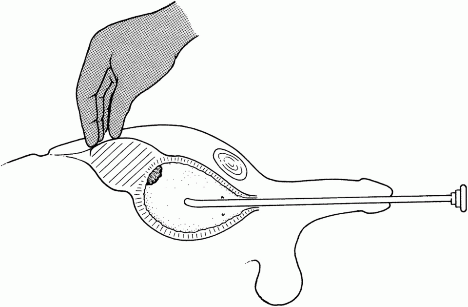 Bladder Neoplasm | Abdominal Key