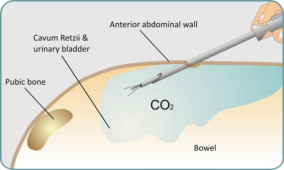 and Laparoscopic Anatomy of the Lower Tract and Pelvis | Abdominal Key