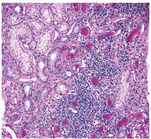 Tubular, Interstitial, and Cystic Disorders | Abdominal Key