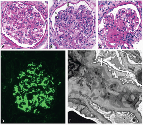 Glomerular and Vascular Disorders | Abdominal Key