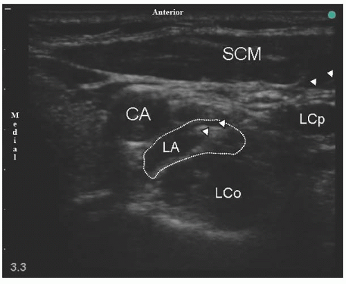 Ultrasound-Guided Cervical Sympathetic Block | Anesthesia Key