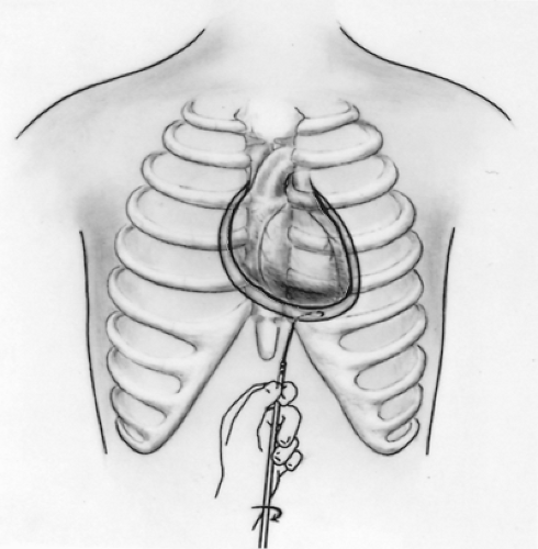 Pericardiocentesis | Anesthesia Key