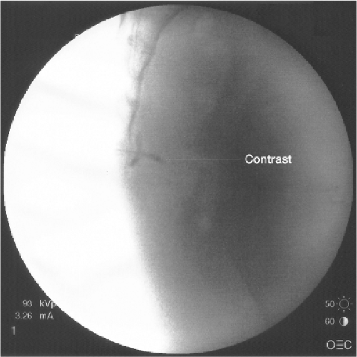 Sympathetic Blocks: Stellate, Celiac, Lumbar, Superior Hypogastric, and ...