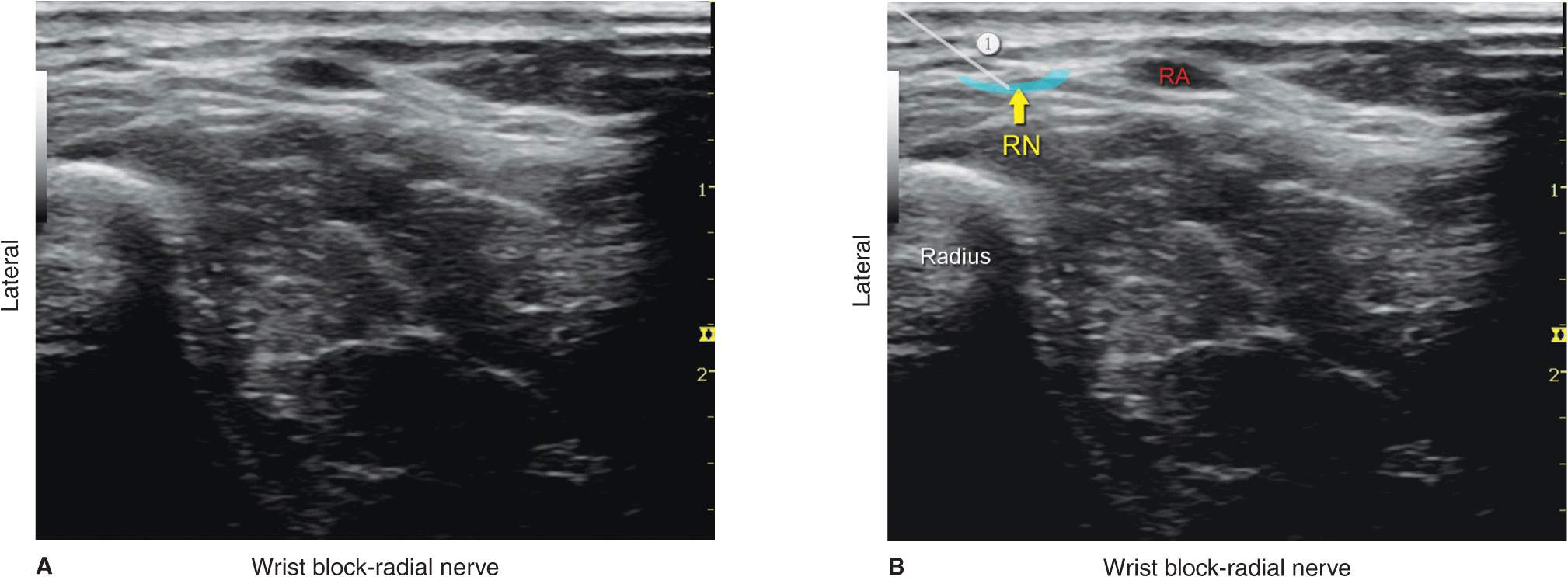 Ultrasound-Guided Wrist Block | Anesthesia Key