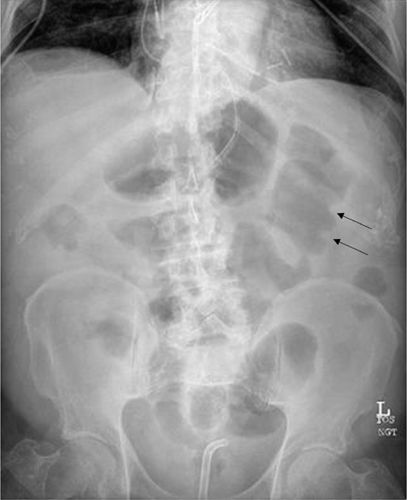 Small-Bowel Obstruction | Anesthesia Key