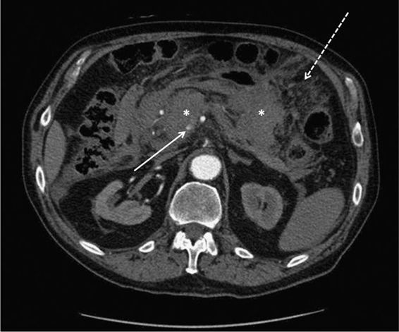 Blunt Intestinal Injury | Anesthesia Key