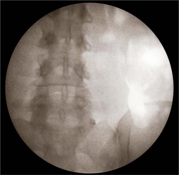 Sacroiliac Joint Denervation by Using Simplicity III | Anesthesia Key