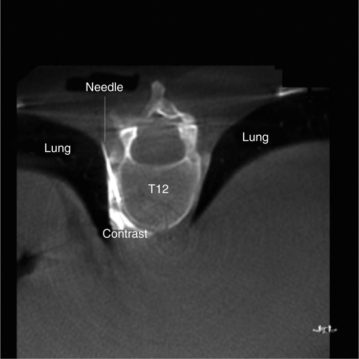 Splanchnic Nerve Blocks | Anesthesia Key