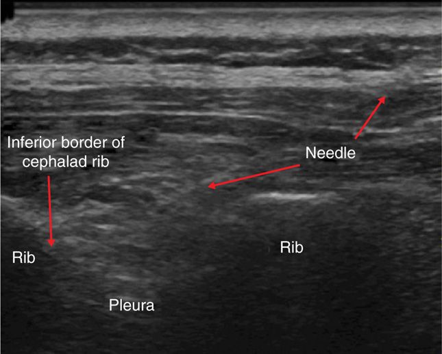 Intercostal Nerve Block | Anesthesia Key