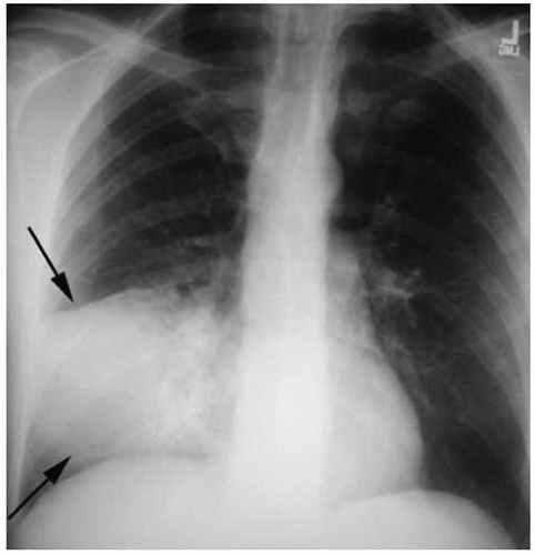 General Management of Medical Conditions in the Wilderness | Anesthesia Key