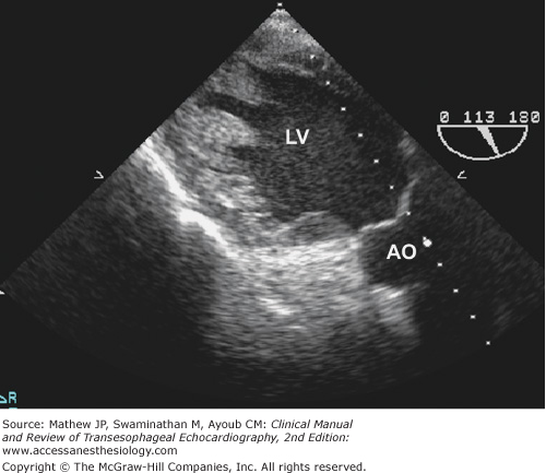 Aortic Valve | Anesthesia Key