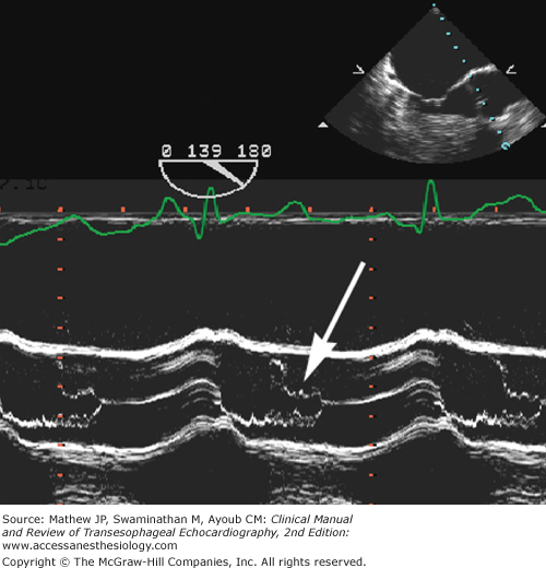 Aortic Valve | Anesthesia Key