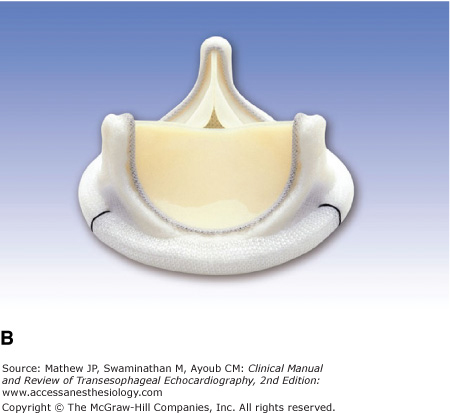 Prosthetic Valves | Anesthesia Key