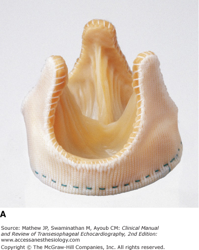 Prosthetic Valves | Anesthesia Key