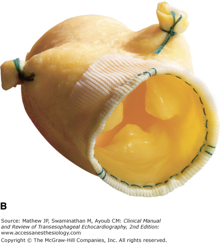 Prosthetic Valves | Anesthesia Key