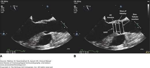 Echocardiography for Aortic Surgery | Anesthesia Key