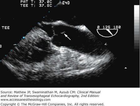 Cardiac Masses | Anesthesia Key