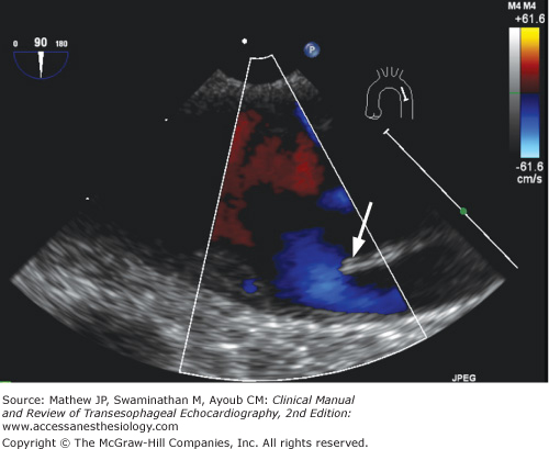 TEE in the Critical Care Unit | Anesthesia Key